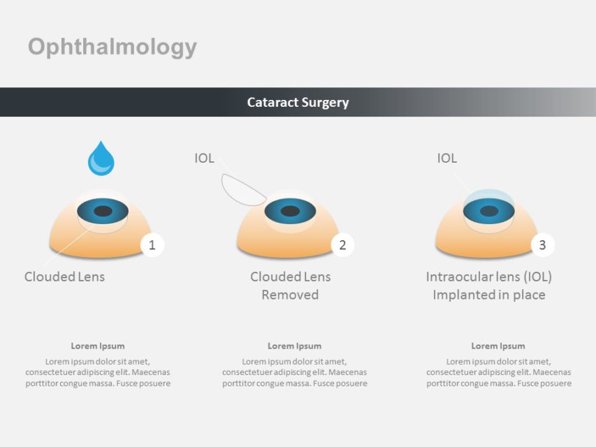 Ophthalmology Cataract PowerPoint Template | SlideUpLift